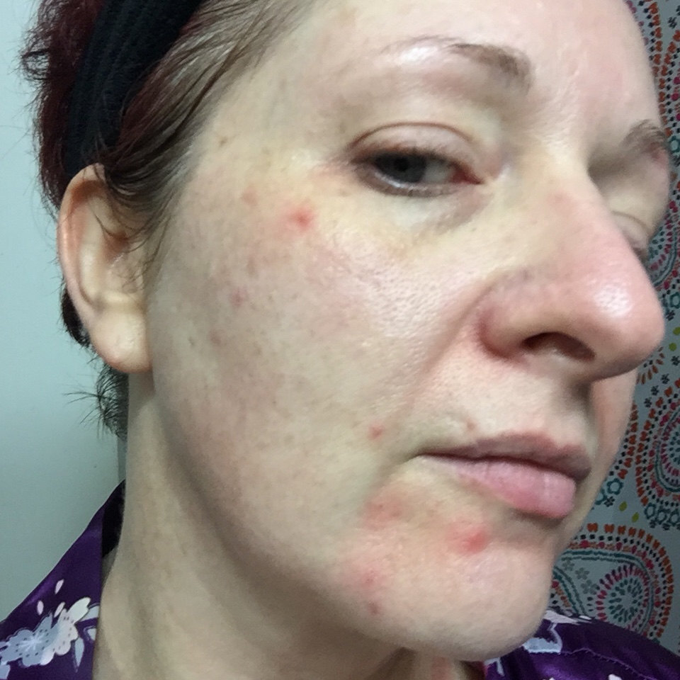 Skin Experiment: Using Differin for Wrinkles – Wrinkles & War Paint