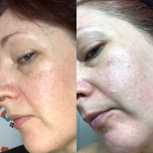 Update 2: Skin Experiment – Using Differin for Wrinkles – Wrinkles ...